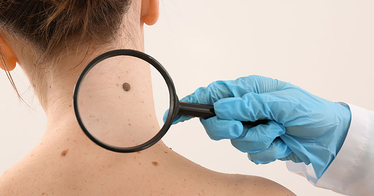 Radiotalasno uklanjanje mladeza | Skin Centar